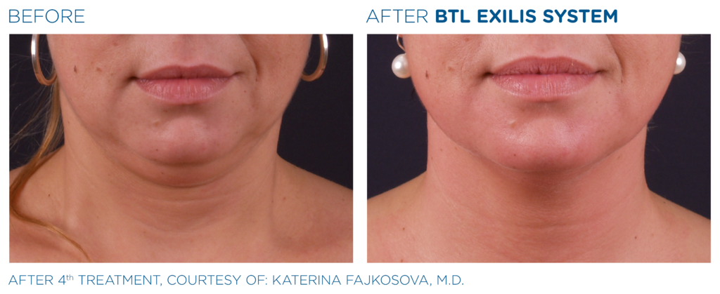 All About the Exilis Ultra - Dr. Bita Farrell