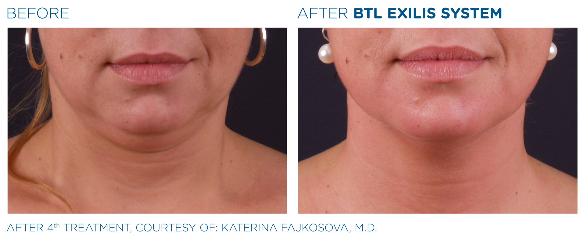 All About the Exilis Ultra - Dr. Bita Farrell
